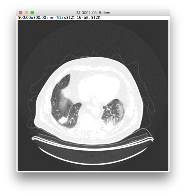 手順 は2つあります。共通の手順は、 CT画像 を読み込んで、肺がん部分を切り出し、 8-bitグレイスケールに変換しておくところまで同じです。