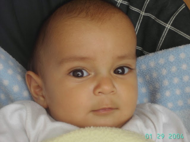 Craniosynostosis: Robert's Head: Unusual head-shape in babies