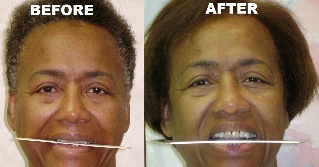 ALF / TREATMENT OF TMJ DISORDER