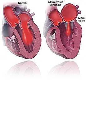 ESTENOSIS MITRAL
