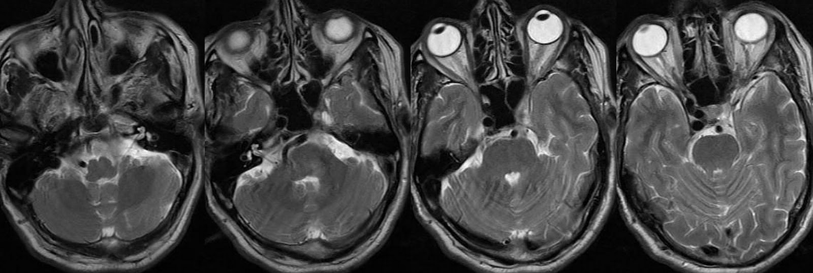Dr Balaji Anvekar FRCR: ICA Unilateral Congenital Absence