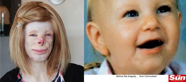 Menina queimada por cigarro da mãe quando era bebê supera dificuldades ...