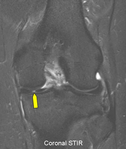 mricases: Radial Meniscal tear