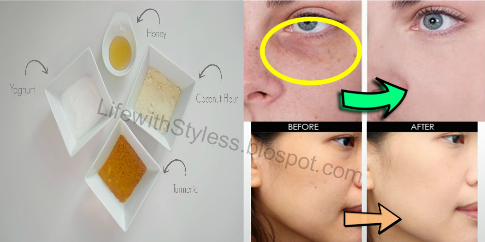 5 Magical Ways to Clear Acne Scars, Dark Marks & Lighten Skin in Less ...