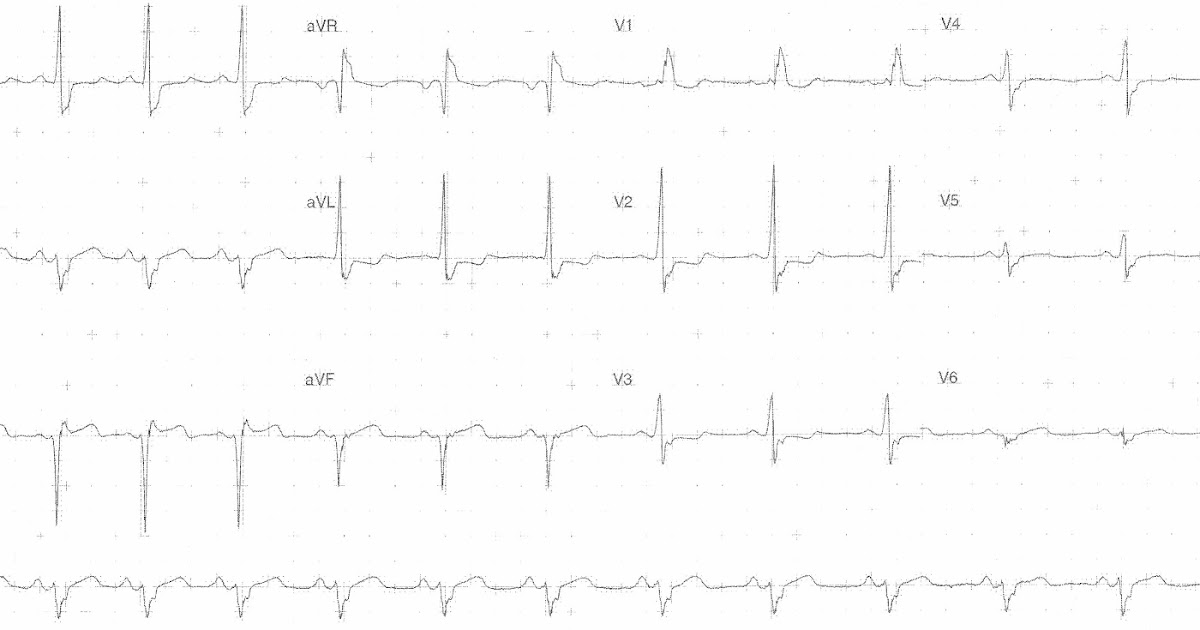 ECG of the Week: ECG of the Week - 10th April - Interpretation