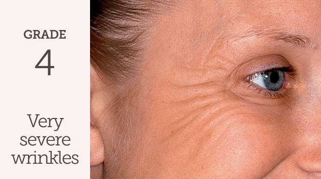 Dr Gerard Ee | Clifford: Crow's Feet - How To Get Rid Of Them?