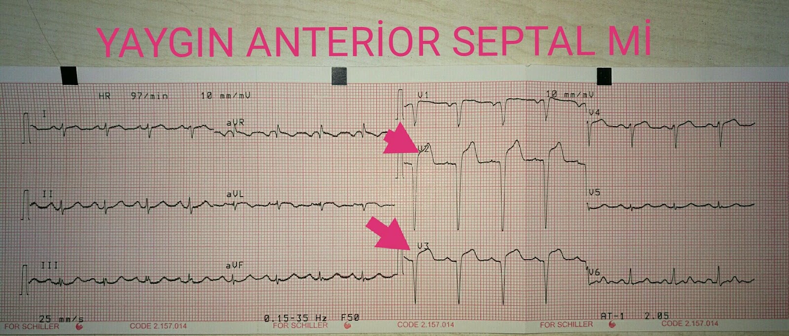 ACİL TANI VE TEDAVİ: AKUT MIYOKARD INFARKTUS ( MI )