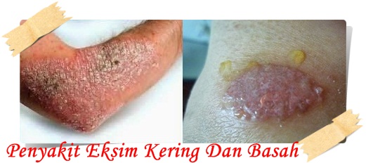 Penyakit Kulit Eksim Basah - Perumperindo.co.id