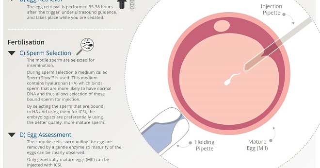 Intracytoplasmic Sperm Injection (ICSI) Fertility Treatment