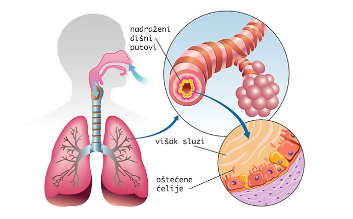 Bronhitis – Uzroci, simptomi i prirodno liječenje kod djece i odraslih