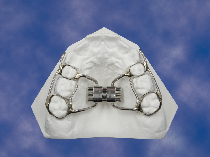 Ortodontia é Arte: O que é Hyrax?