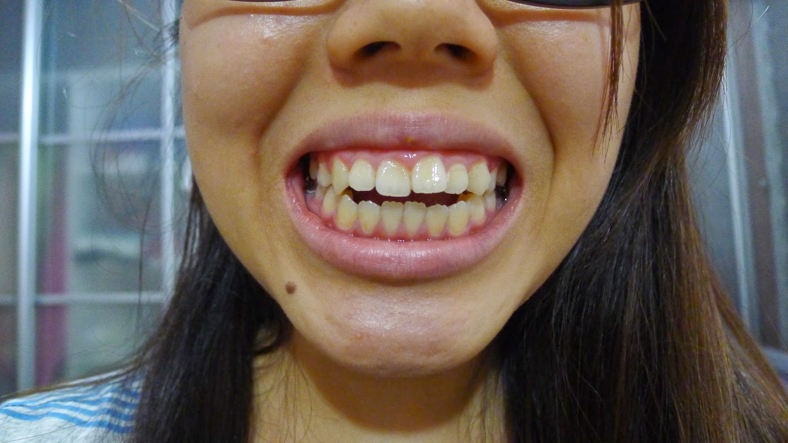 Of lifestyle, braces and good food: Journey of becoming a metal-mouth girl