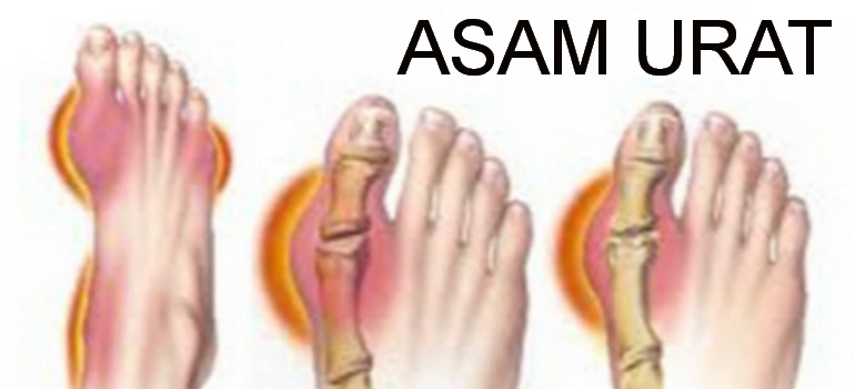 Beberapa Sebab terjadinya Asam Urat