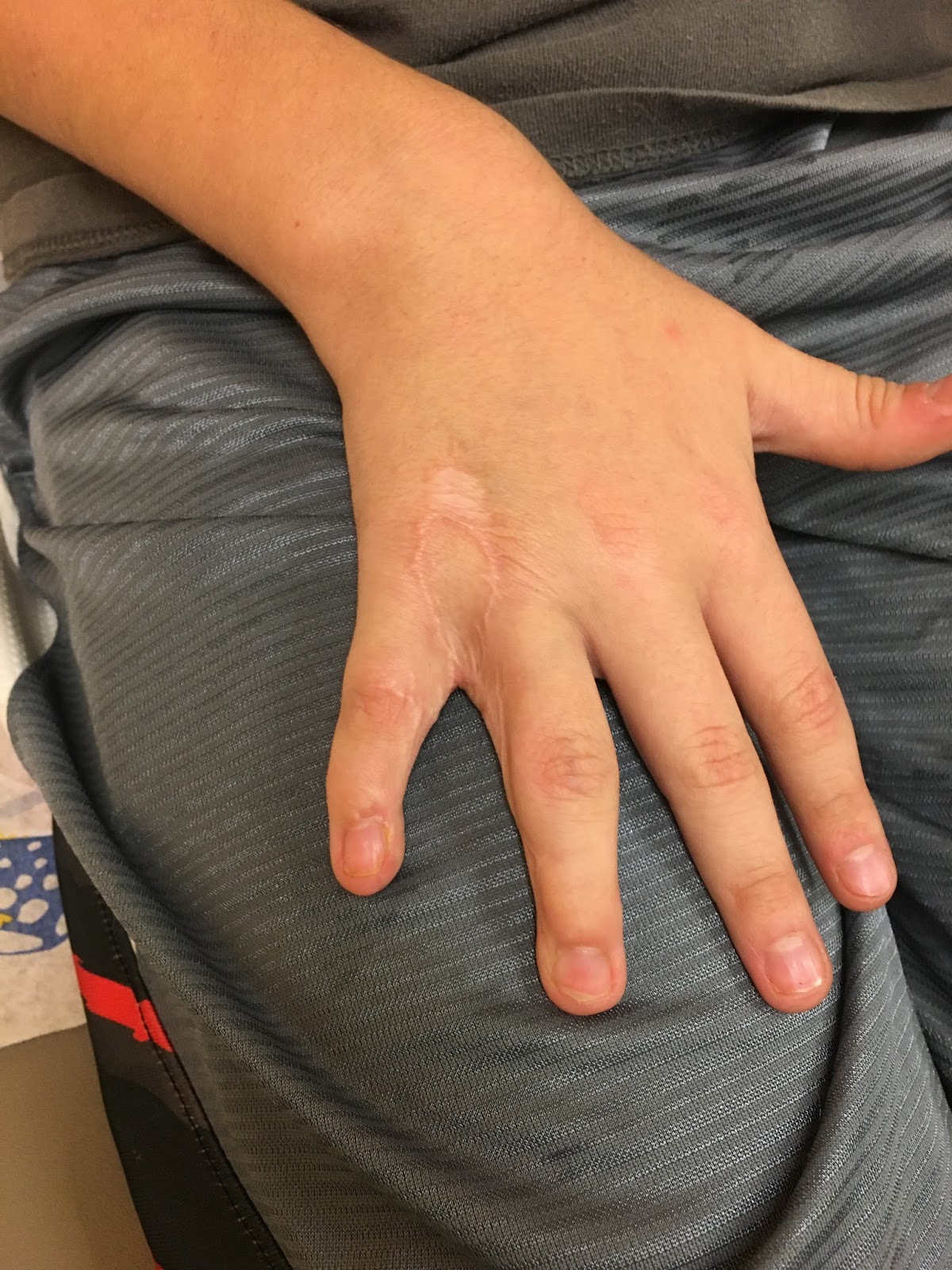 Syndactyly Revision Surgery | Congenital Hand and Arm Differences ...