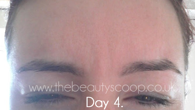 The Beauty Scoop!: The Botox Diaries - Days 1 to 4!