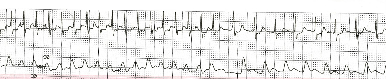 EKG Rhythm Strips of Unstable SVT with Arterial Blood Pressure Waveform