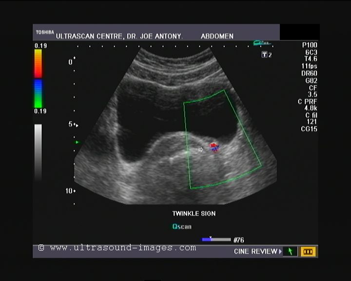 cochinblogs: Twinkle (color Doppler) artifacts in urinary calculi