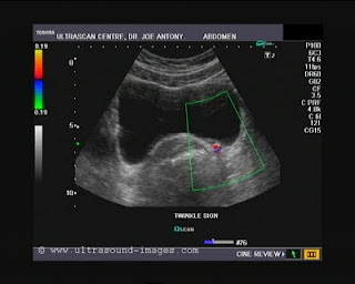 cochinblogs: Twinkle (color Doppler) artifacts in urinary calculi