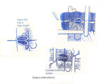 OTMANAGE: Bowel Anastomosis