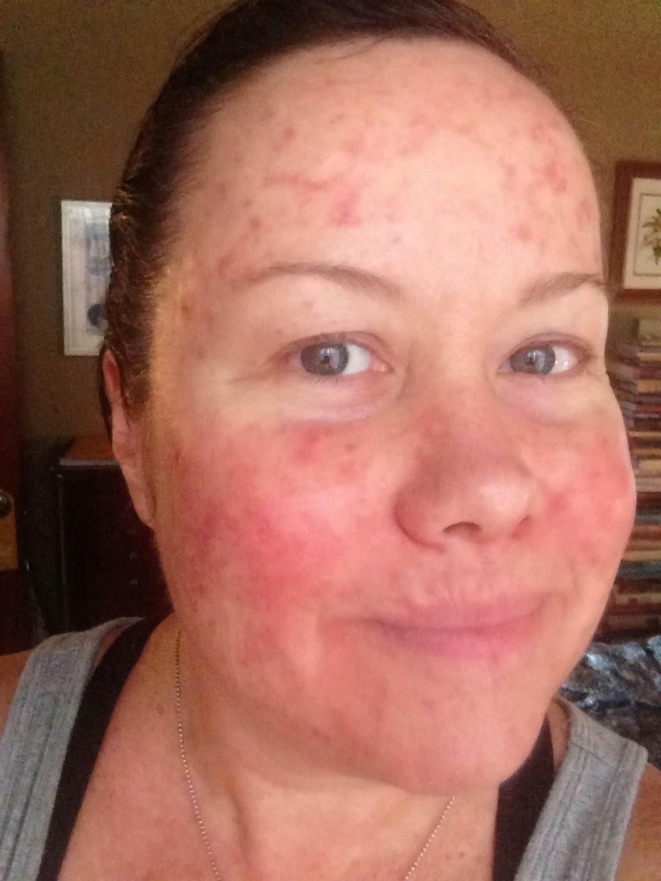 Efudex (Fluorouracil) Adventure: Efudex Days 1-9