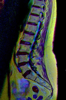 Nevit's blog: Color MRI of spine