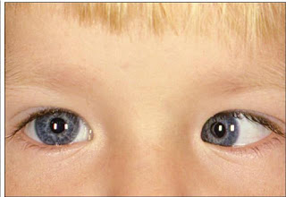 Anomalías de los Movimientos Oculares: Hirschberg
