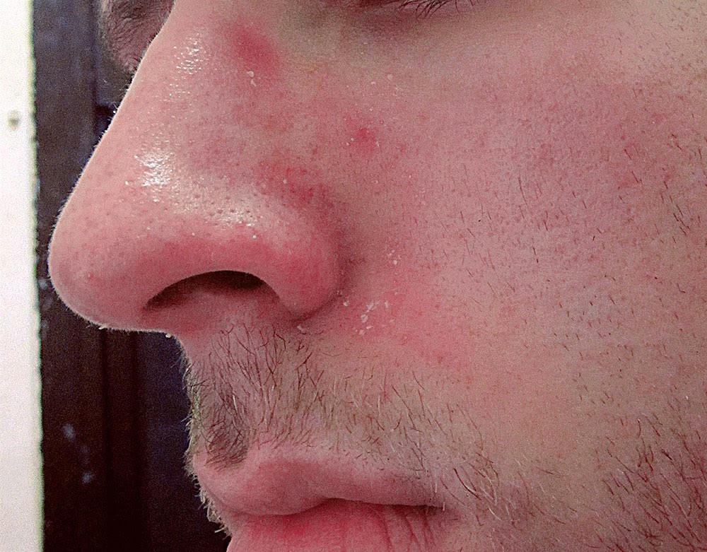 SKIN DISEASE TYPES: Seborrheic Dermatitis