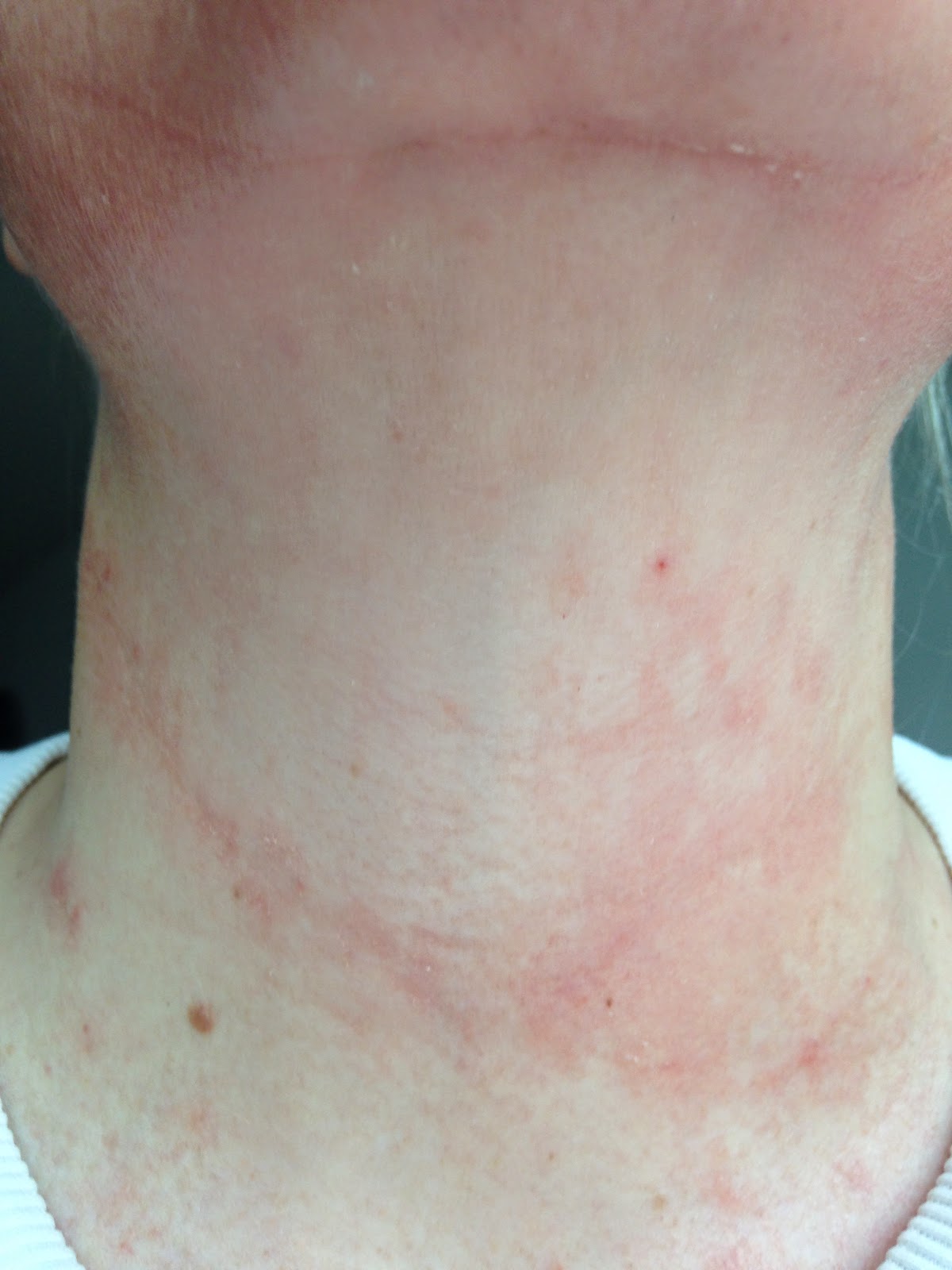 My Obagi Nu-Derm experience : Week 2 - My face is settling to a pink ...