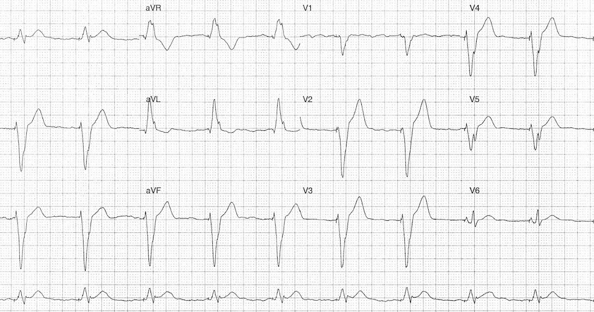 ECG of the Week: ECG of the Week - 25th December 2017 - Interpretation