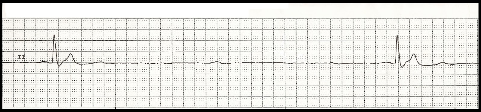 Float Nurse: EKG Rhythm Strips 91 Various Agonal Rhythms