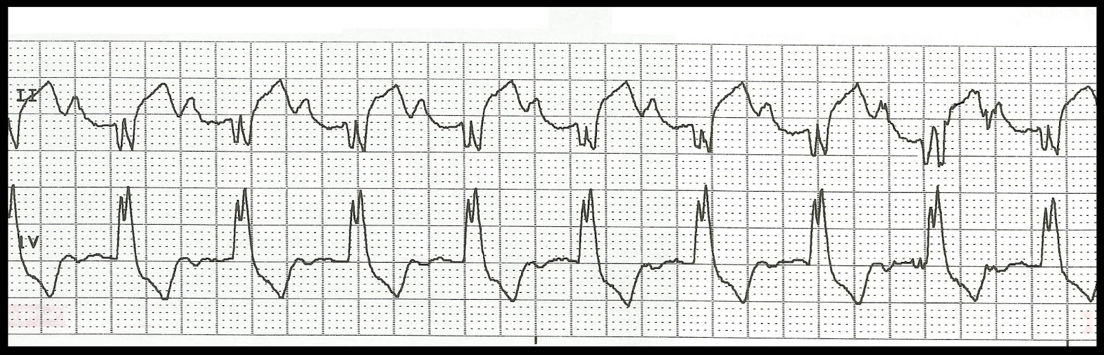 Practice ECG Rhythm Strips 112