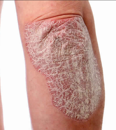 psoriasis: Psoriasis