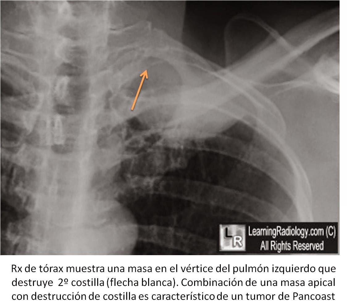 ESPE 203-2013: Caso clínico: tumor de Pancoast