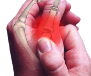 Entumecimiento En Las Manos | El Sindrome Del Tunel Carpiano