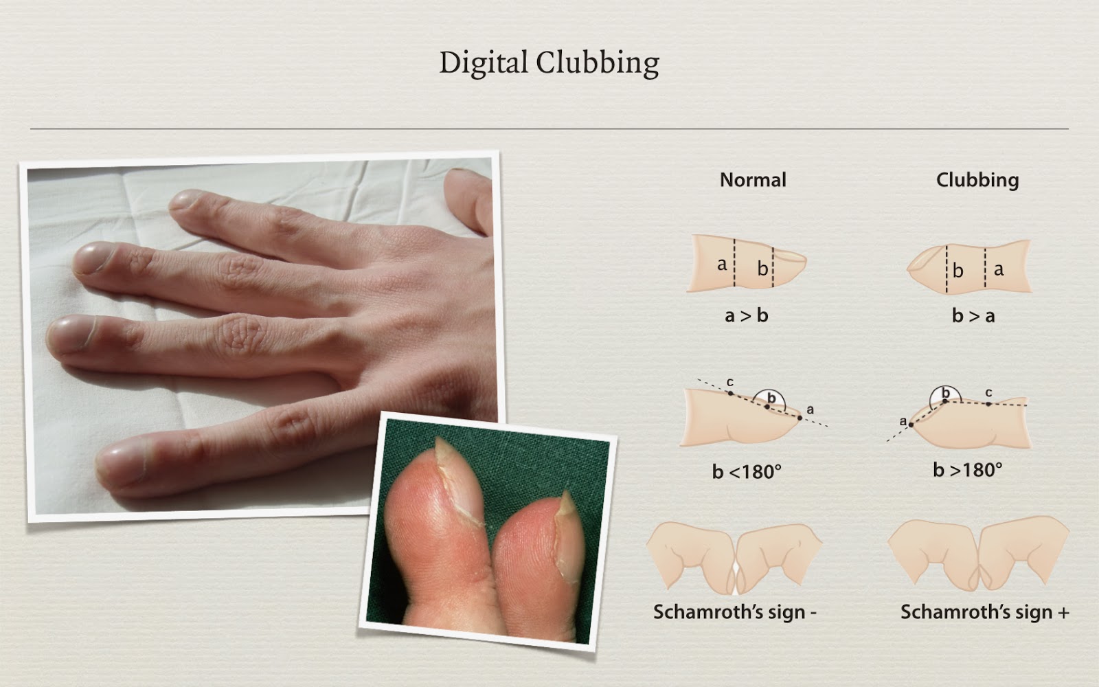 Naut's Medical Tips: ภาวะนิ้วปุ้ม หรือ นิ้วกระบอง (Digital Clubbing)