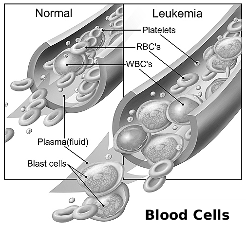 leukemia cancer specialist