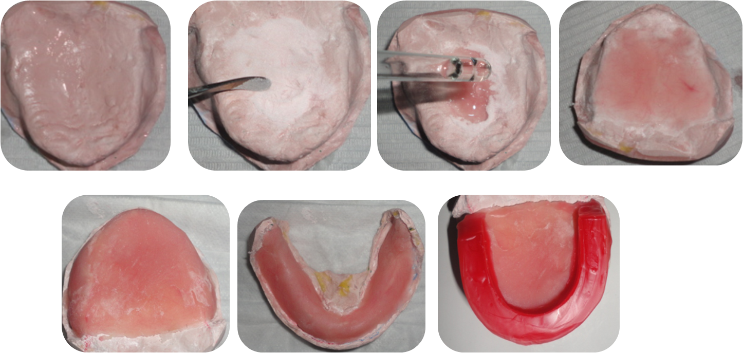 odontologosPerú: Prótesis Total: Zona Neutra