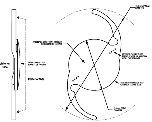 Jigar Bathia: Improved Dependability With The New Toric IOLs