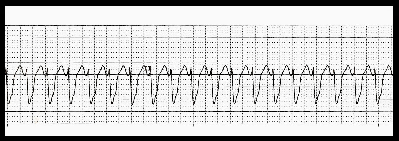 EKG Rhythm Quiz 278: Ventricular Rhythms