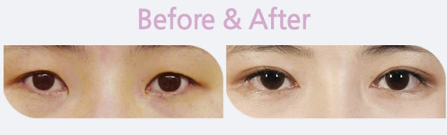 BK Plastic Surgery: [BK Plastic Surgery] Eyelid Surgery:Outer Corner ...