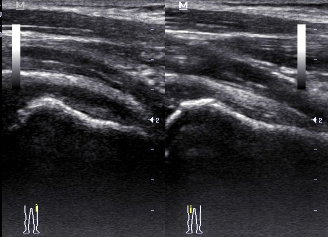 EcoCyl-Msk: Sinovitis transitoria de cadera