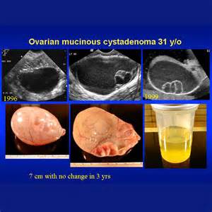 PUNCA DAN JENIS JENIS CYST YANG WAJIB ANDA TAHU - CUTE AND BEAUTY