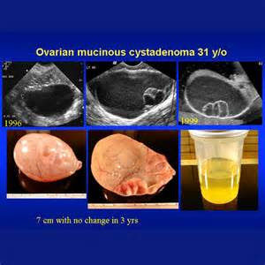 PUNCA DAN JENIS JENIS CYST YANG WAJIB ANDA TAHU - CUTE AND BEAUTY