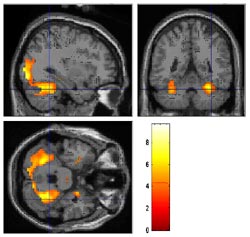 Brain Points: Psychopaths: Born evil or with a diseased brain?