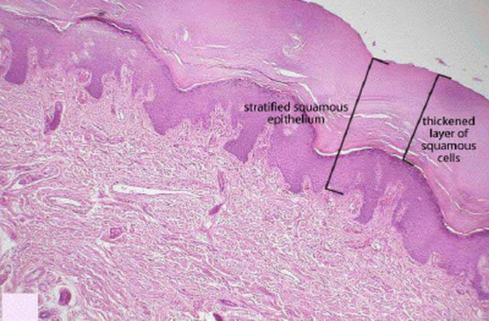 We Know Mohs: Slide Review: Thick skin and sun damaged skin