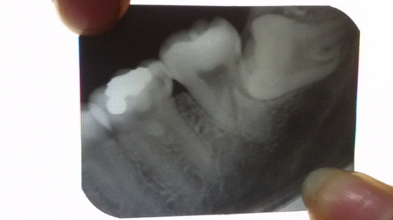 rayosxmaxilofacial: CASO CLÍNICO: TERCER MOLAR IMPACTADA
