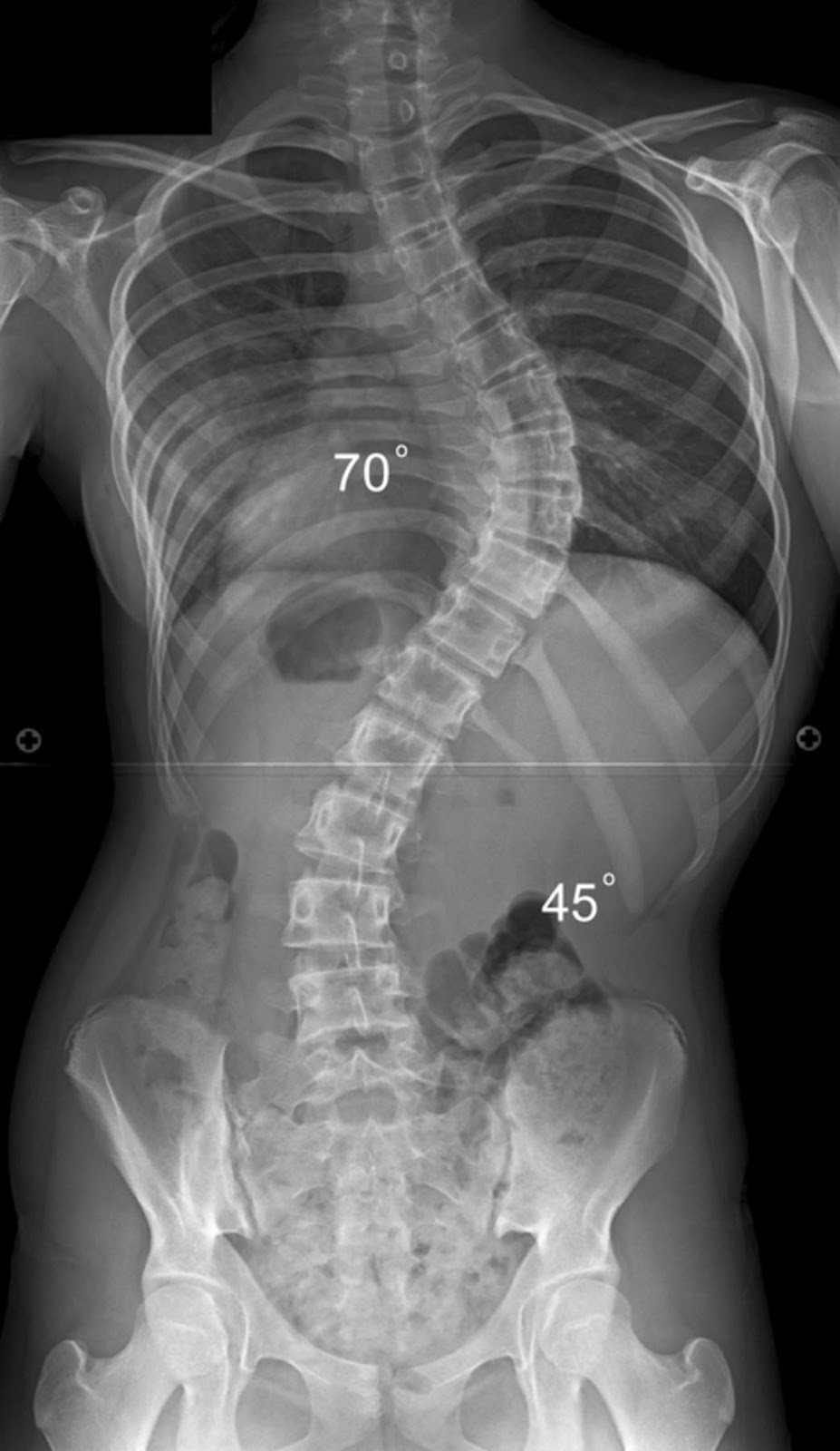 Chiropractic Helps With.....: Scoliosis