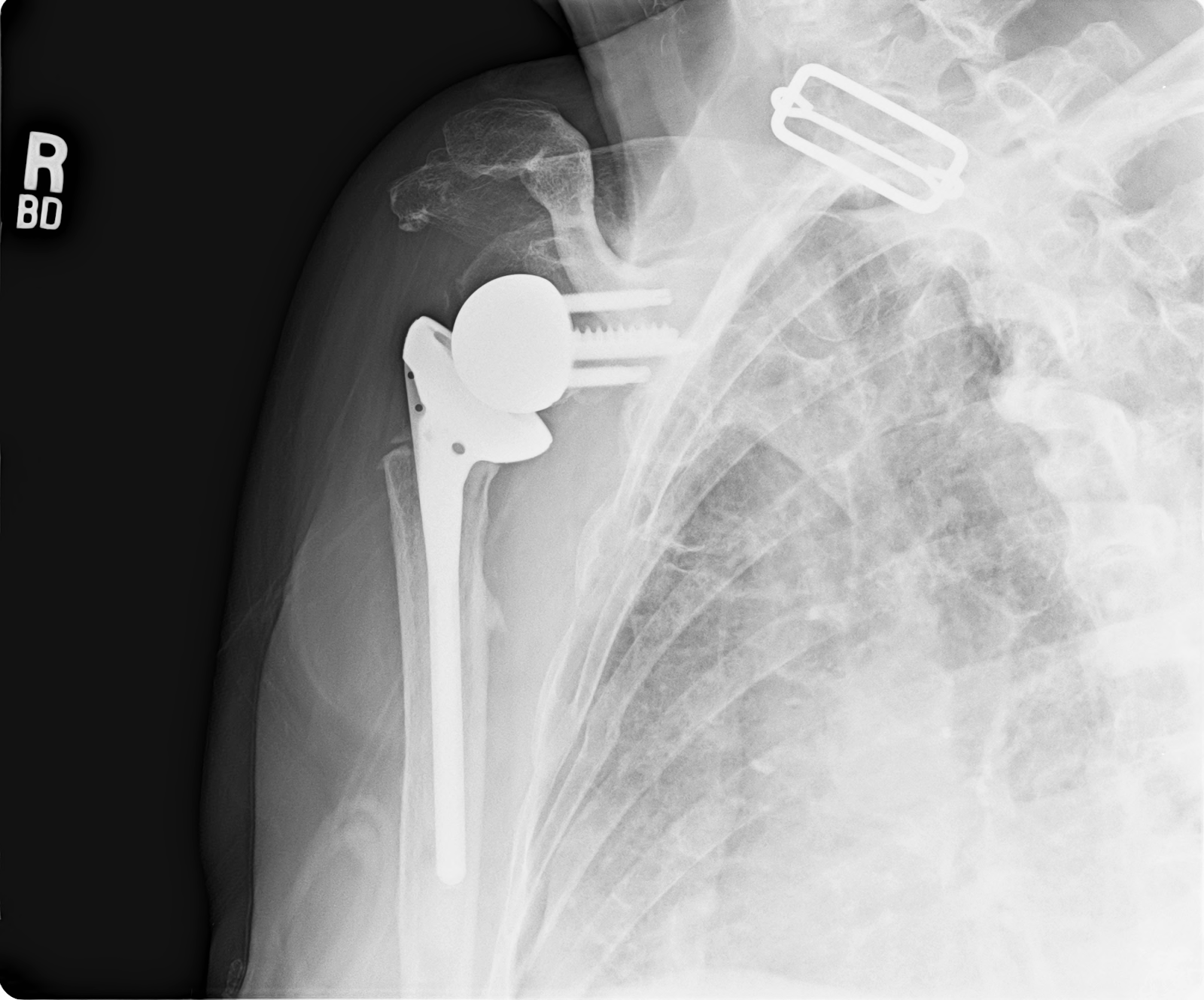 Shoulder and Elbow Surgery: Proximal humerus nonunion in the elderly ...
