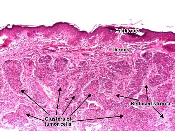 Histology and Explanation of Basal cell carcinoma ~ MdBlogger