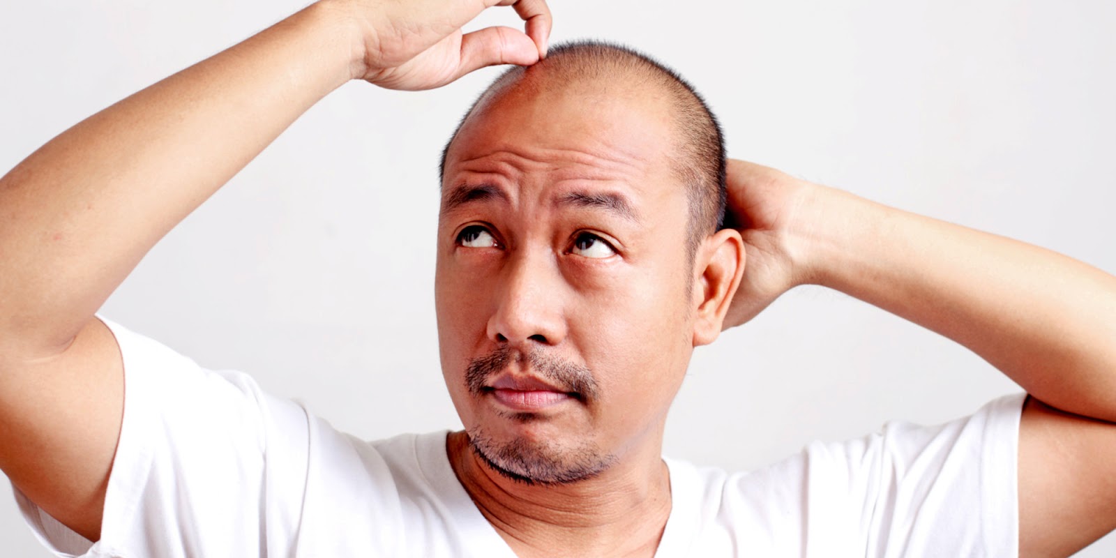 Inilah Beberapa jenis Rambut Botak